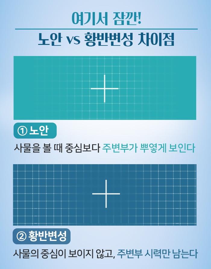 인구 고령화로 급증하는 실명 질환 황반변성