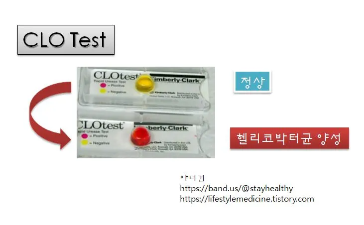 항생제에 죽지 않는 헬리코박터? - 내성돌연변이검사