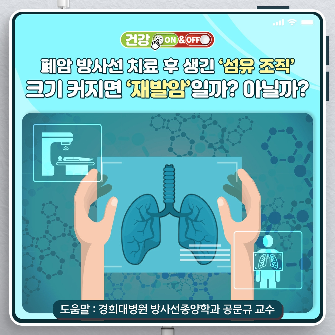 폐암 방사선 치료 후 생긴 ‘섬유 조직