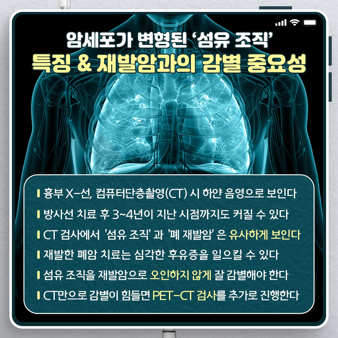 폐암 방사선 치료 후 생긴 ‘섬유 조직