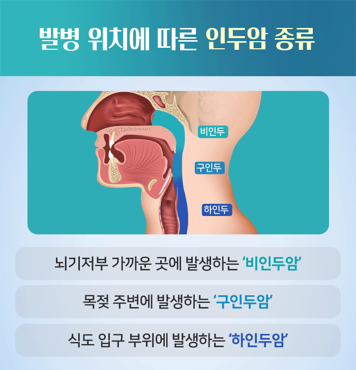 전이율 높아 치명적인 ‘인두암