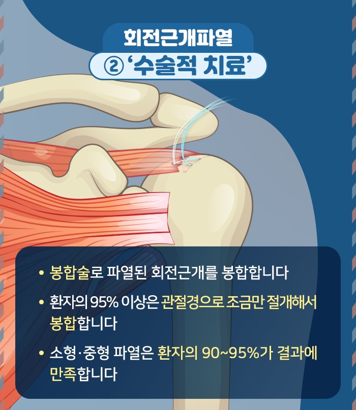 어깨 힘줄 끊어진 ‘회전근개파열
