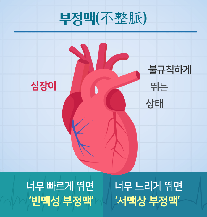 뇌졸중 위험 높이는 부정맥 ‘심방세동