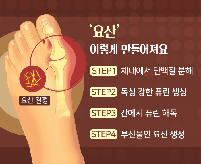 술‧육류 즐기는 남성의 질환 ‘통풍