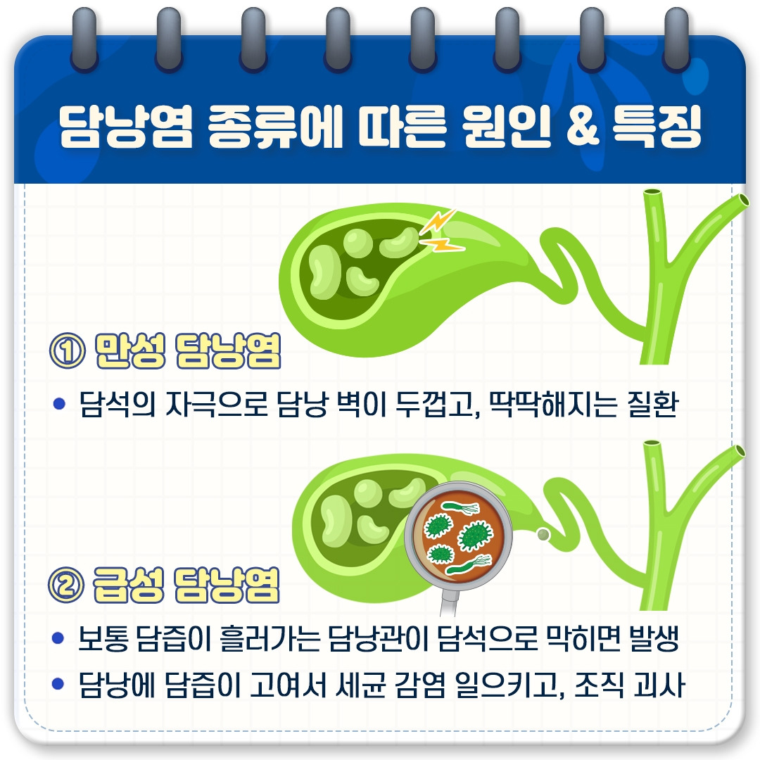 돌 없는 ‘급성 무담석 담낭염