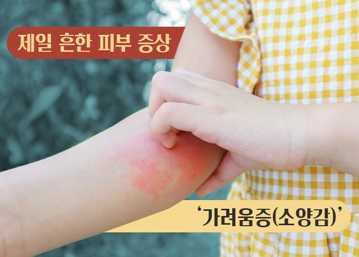 기온 오르며 찾아온 ‘피부 가려움증