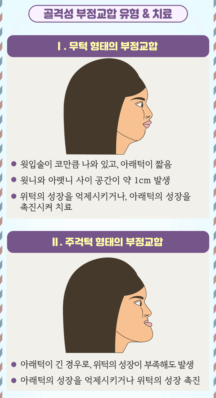 삐뚤빼뚤 치아 ‘부정교합