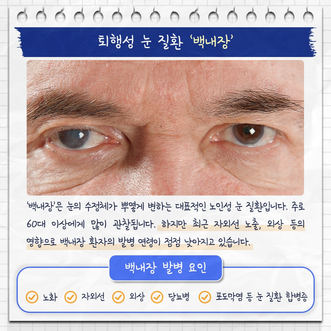 백세시대 백내장 수술 두 번 가능