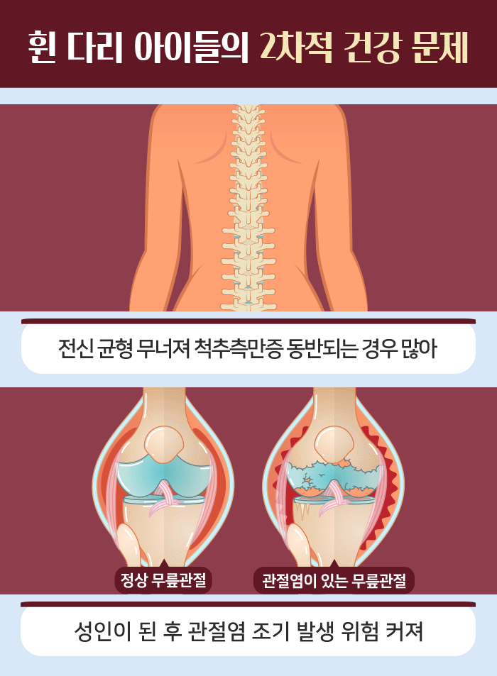 방학 때 살펴보세요 우리 아이 ‘휜 다리