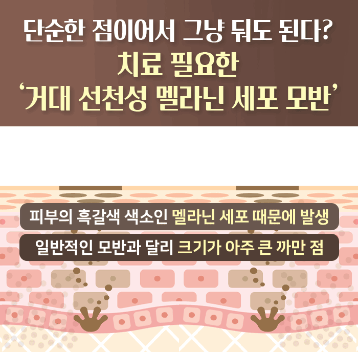 우리 아기 선천성 ‘멜라닌 세포 모반