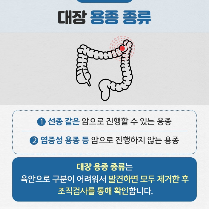 대장암 예방 첫걸음 대장내시경 And 용종 절제