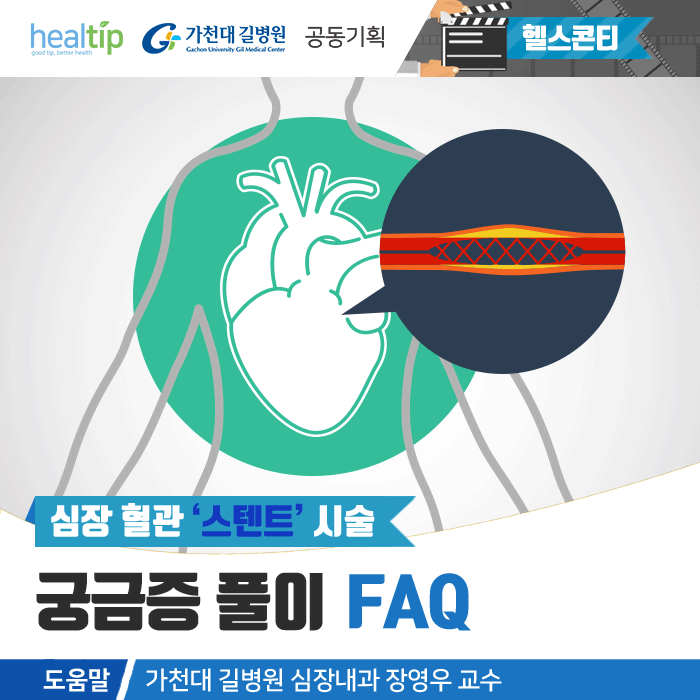 심장 혈관 ‘스텐트 시술
