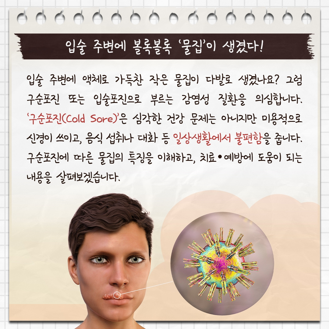 입술 주변에 물집 있는데 키스