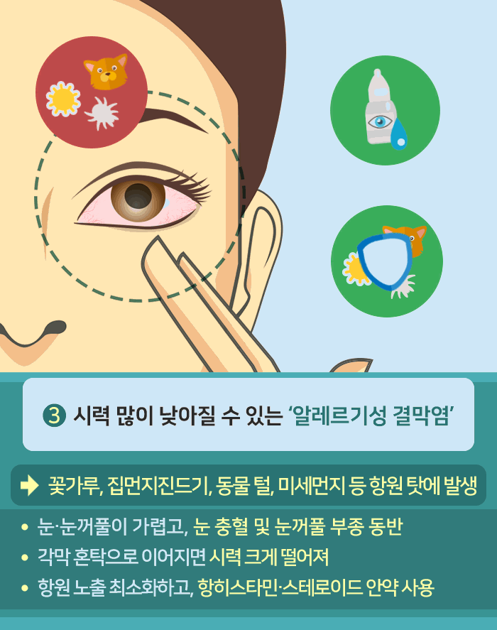 단순한 눈 불편감에 그치지 않아요