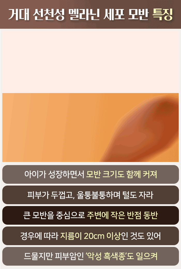 우리 아기 선천성 ‘멜라닌 세포 모반