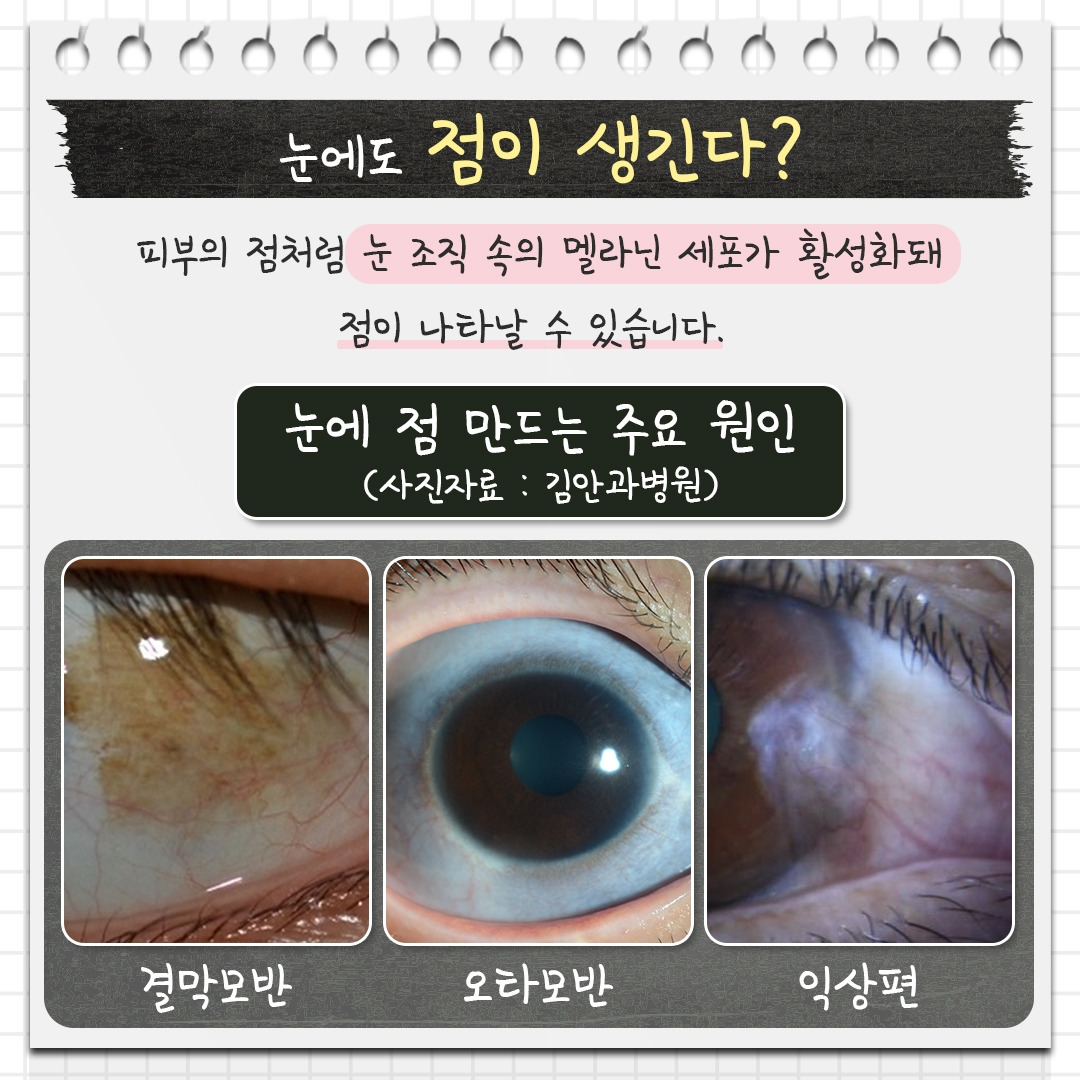 눈에 점이 생겼어요