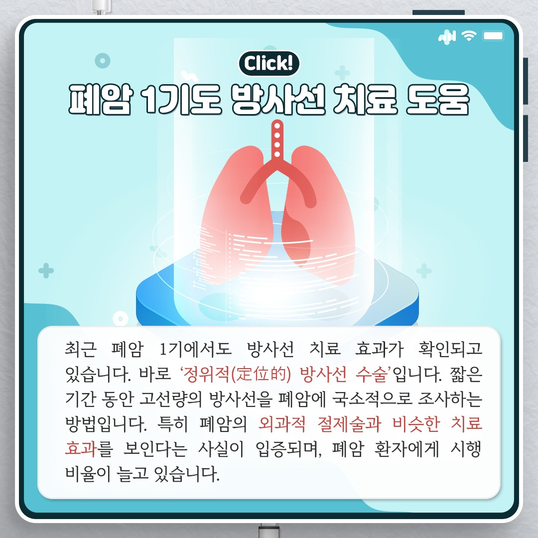 폐암 방사선 치료 후 생긴 ‘섬유 조직