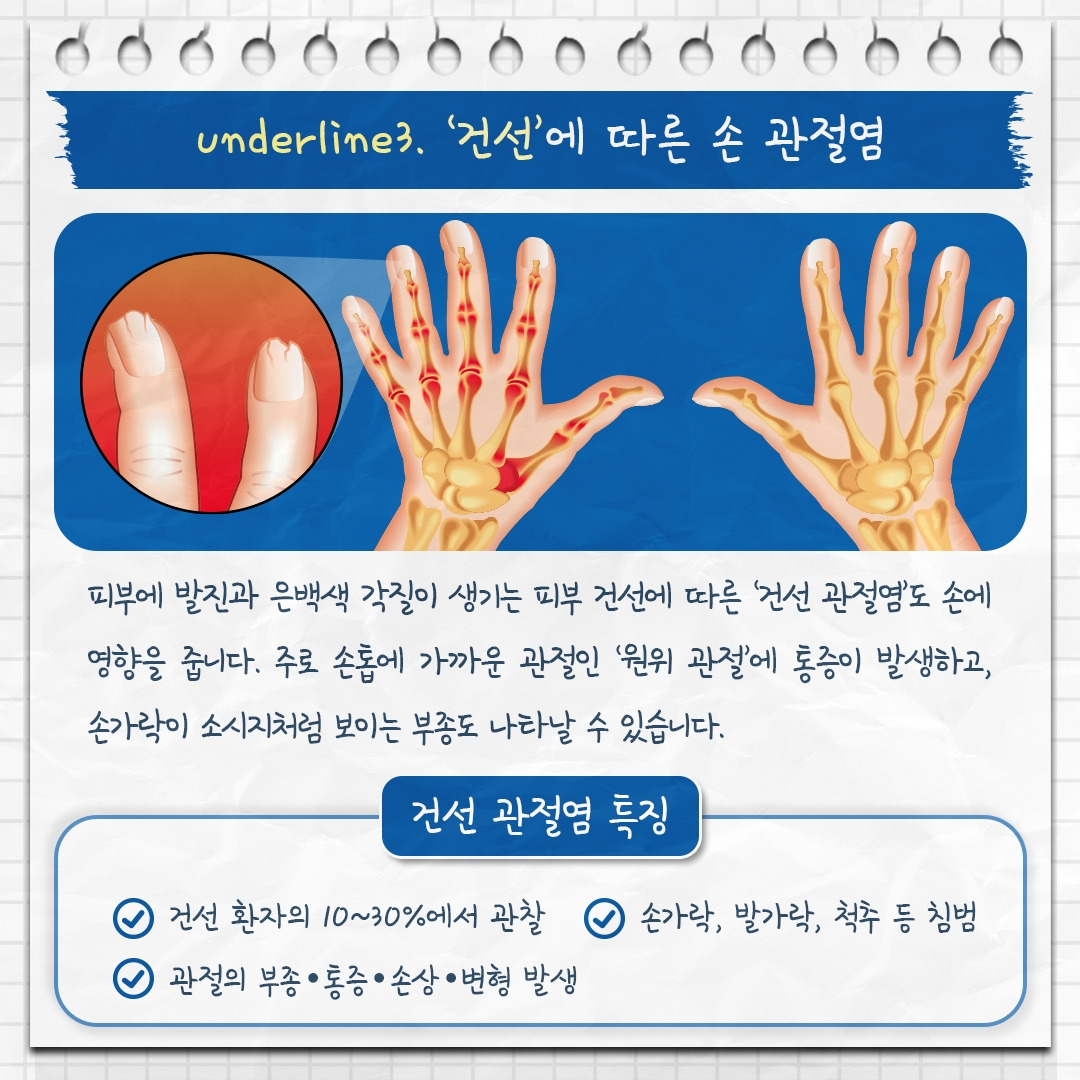 손가락이 붓고 아파요‧‧‧