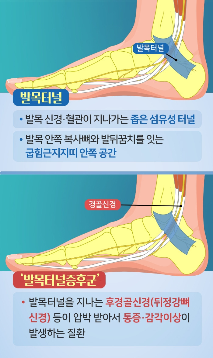 삐끗~ 습관적 발목 염좌 방치하면 찾아오는
