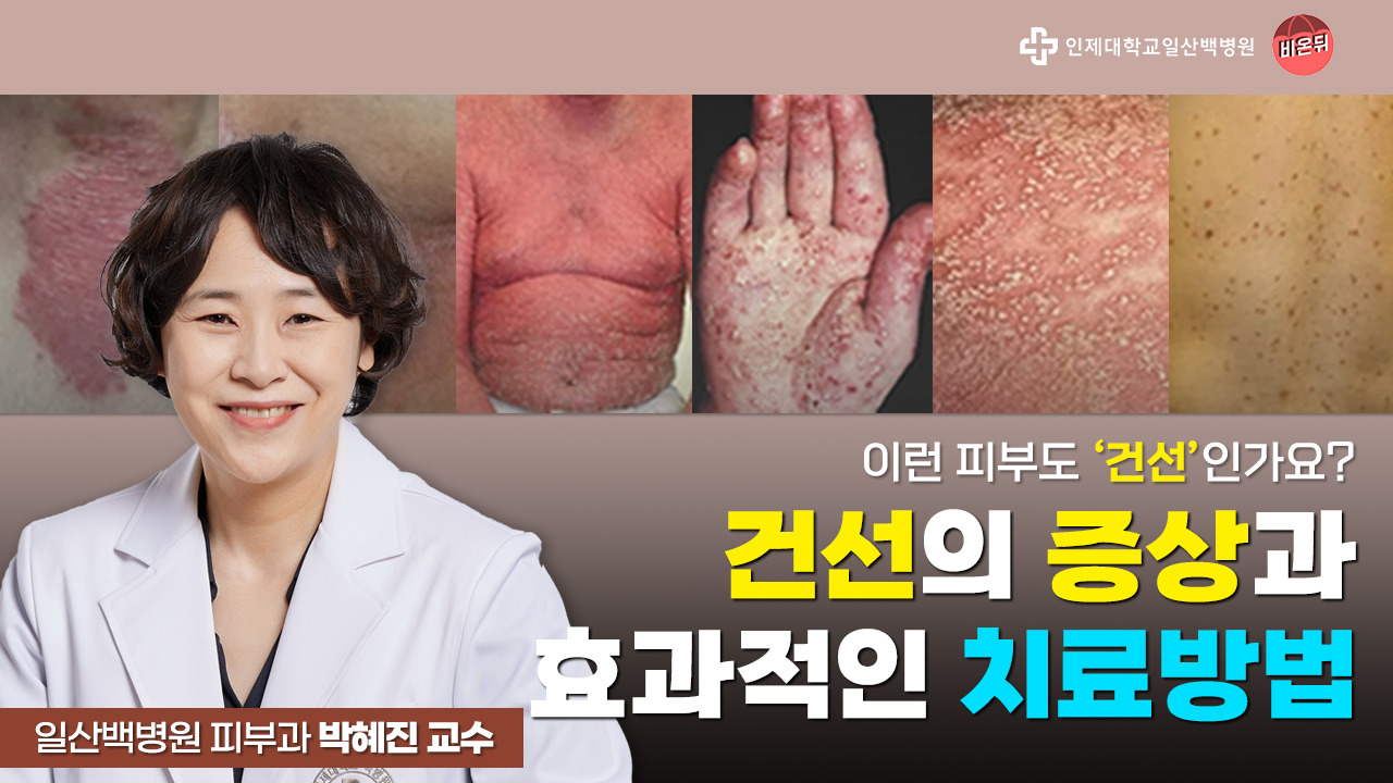영상 피부가 건조하면 건선이 생긴다