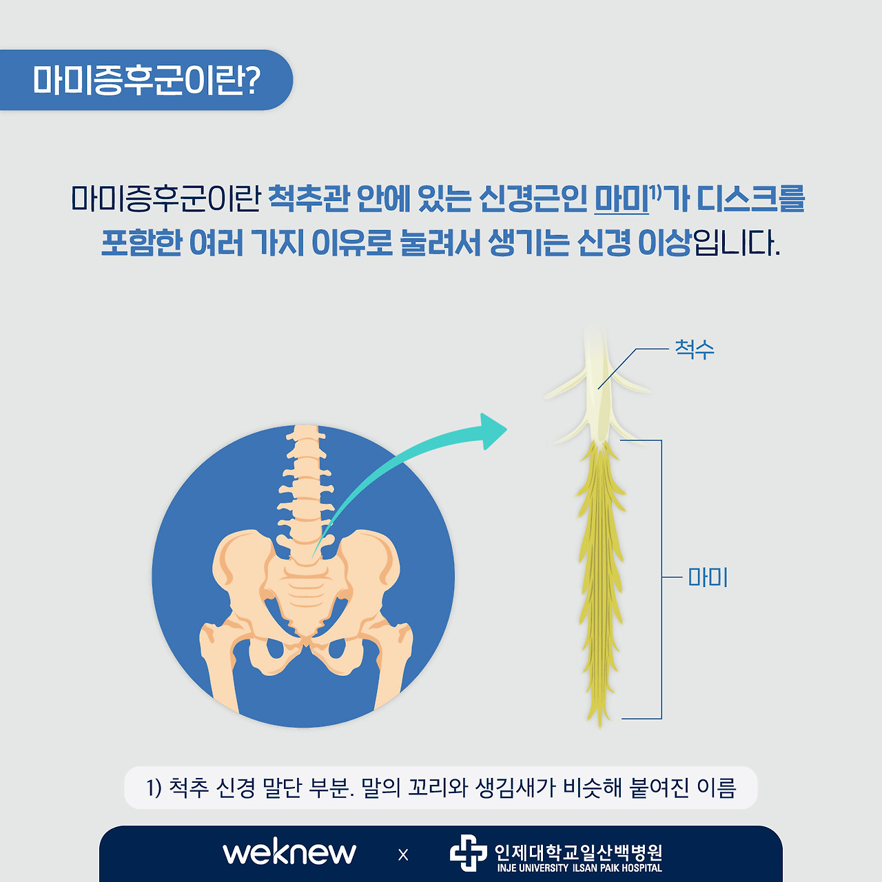 허리통증 · 배변장애 마미증후군 증상