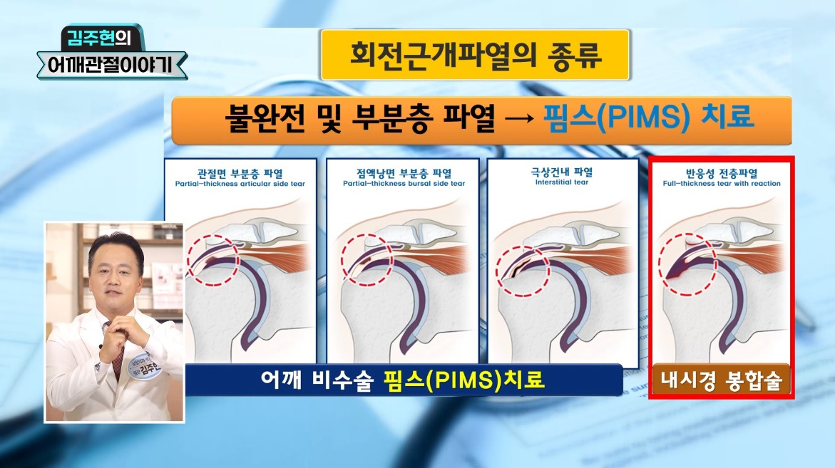 어깨 회전근개파열 치료방법 비수술 핌스 치료