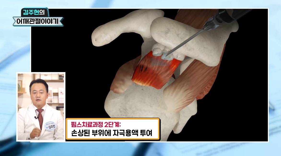 어깨 회전근개파열 치료방법 비수술 핌스 치료