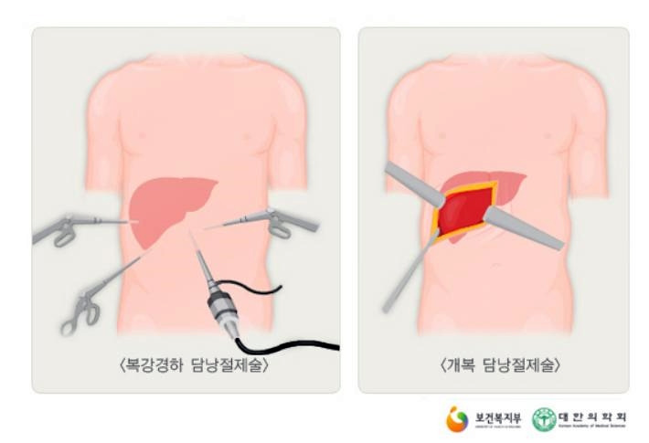 담낭절제술 수술 후 관리와 회복 기간
