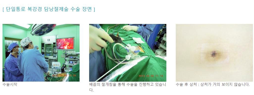 담낭절제술 수술 후 관리와 회복 기간