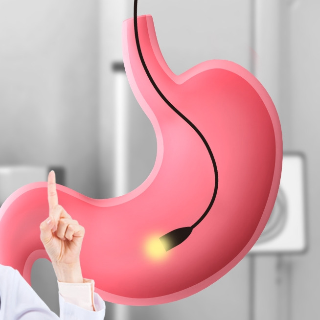 조기 위암 내시경적 치료로 위암생존율 높인다