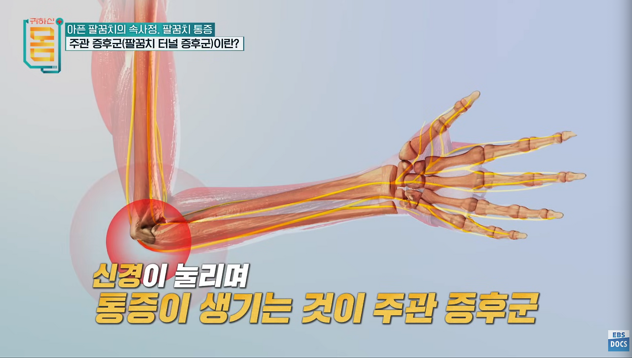 테니스 엘보 골프 엘보 자가 진단 및 치료법