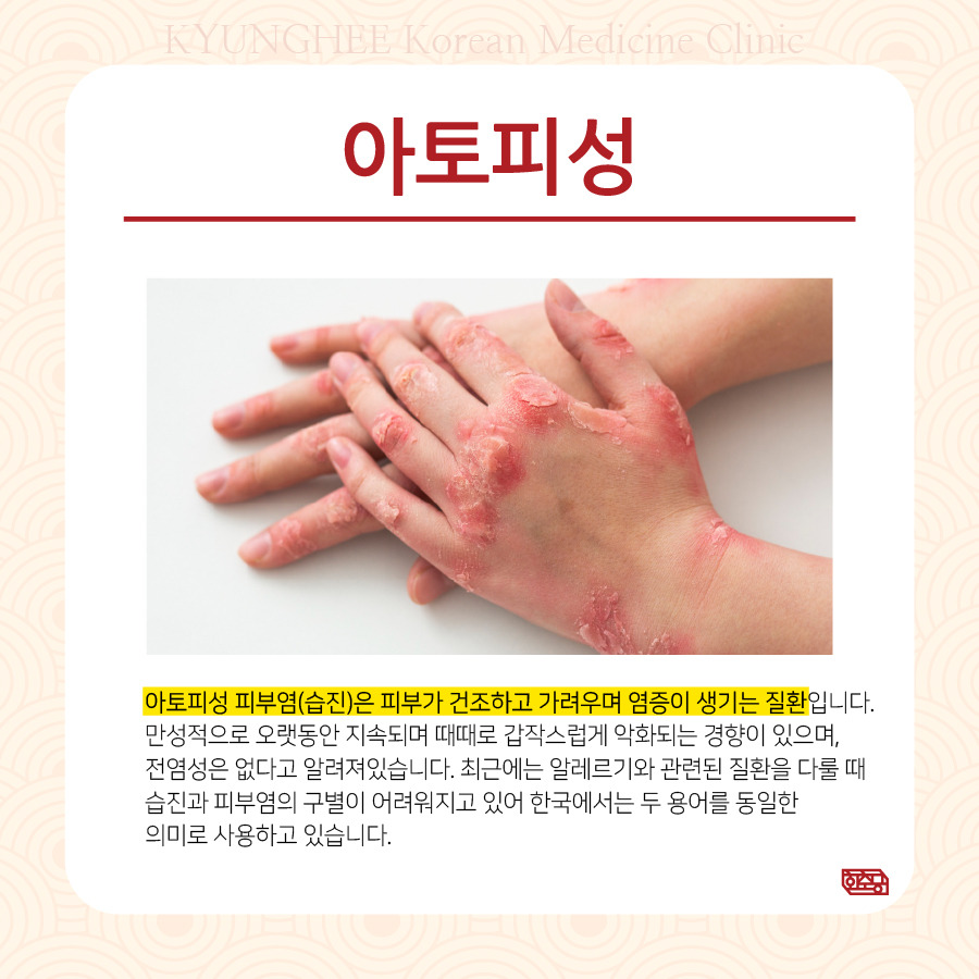 지루성피부염과 만성피부질환 한방치료방법