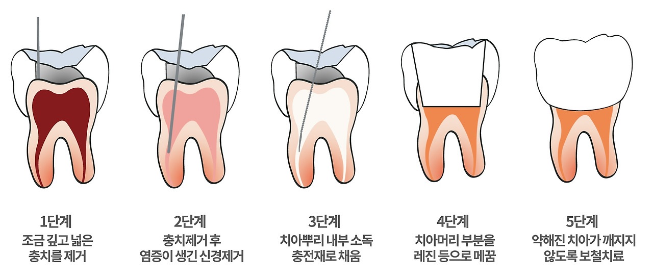 상상 그 이상의 경험 신경치료