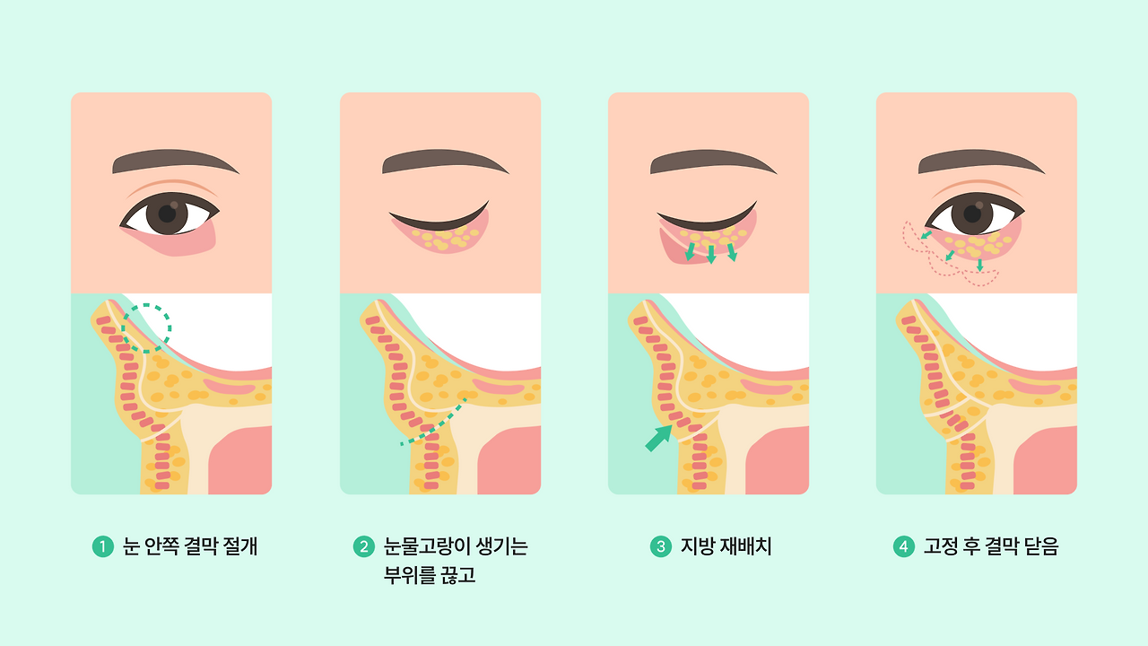 5년은 젊어진다는 눈밑 지방 재배치