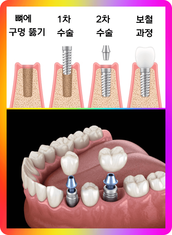 임플란트 비용 가격 부작용 종류별 수명 및 임플란트 뼈이식 보험 가격 정보