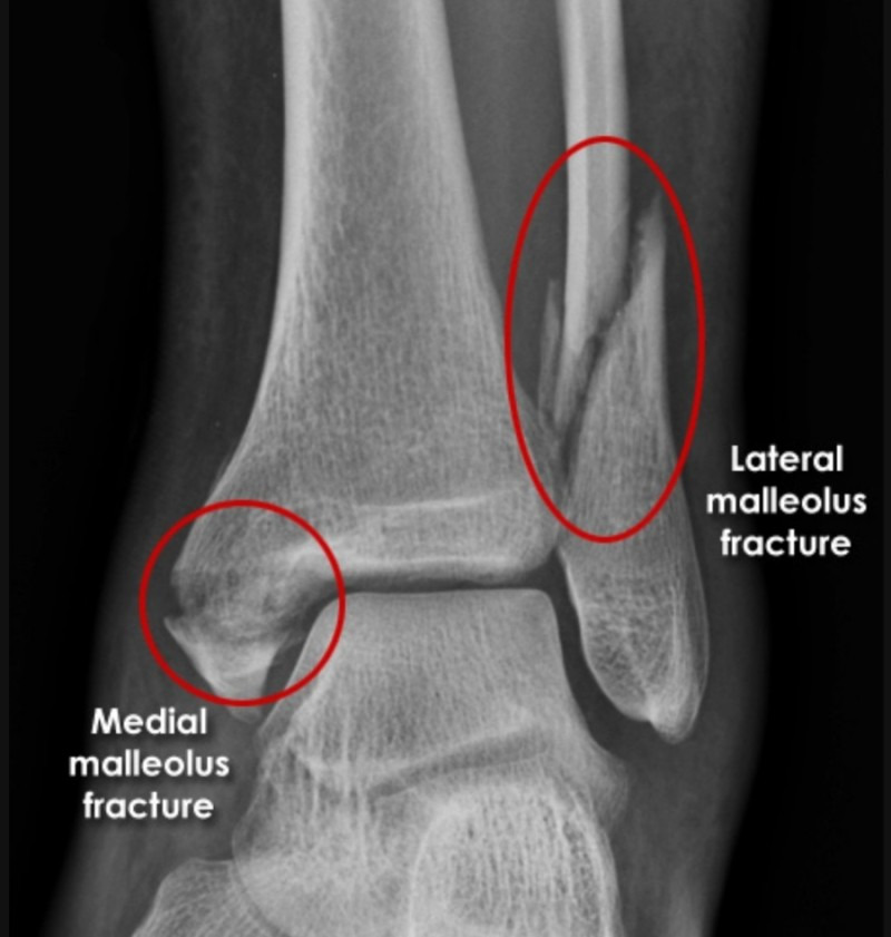 정형외과스크럽 ORIF ankle fx op(bimalleolar fx. trimalleolar fx)