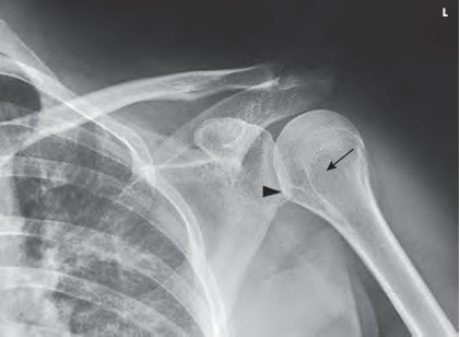 일반촬영 x-ray 엑스레이 어깨(shoulder series) - shoulder AP 촬영방법