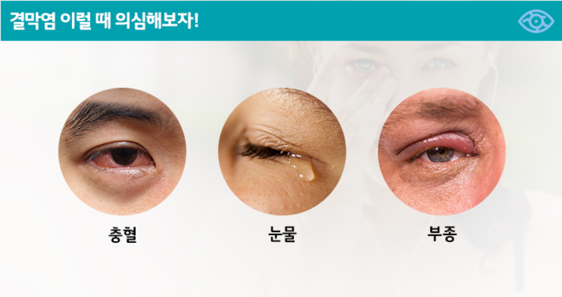 알러지 결막염 증상과 치료 정보 건강 쉼표