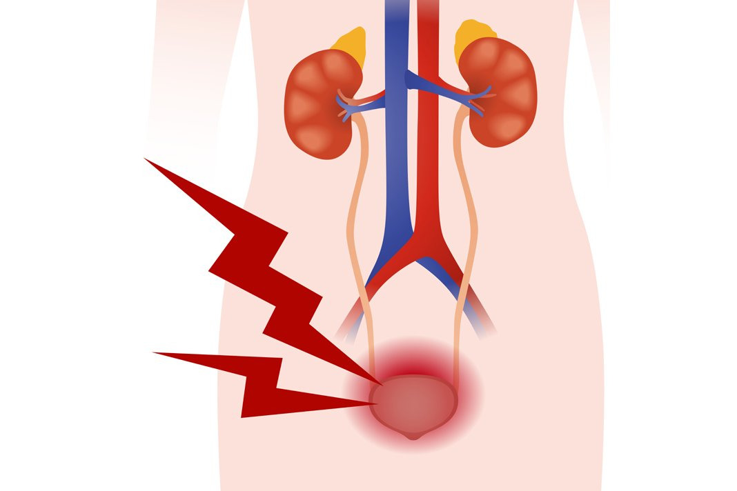 단백뇨의 원인 7가지 및 증상 치료 예방 총정리