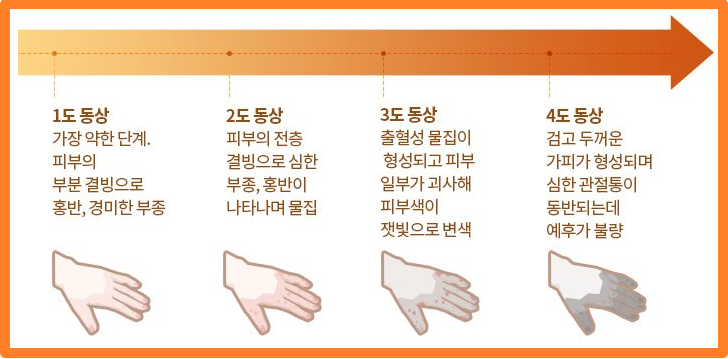 발가락 동상 연고
