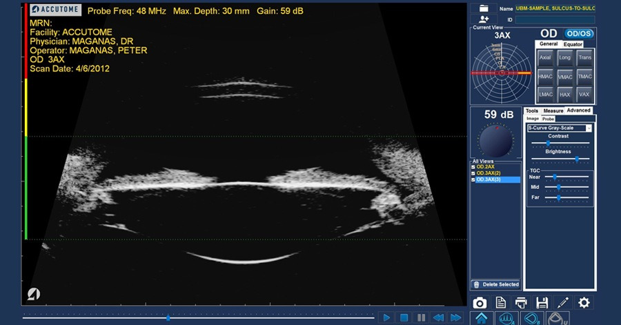 초음파 생체 현미경 검사 (UBM, Ultrasound BioMicroscopy)