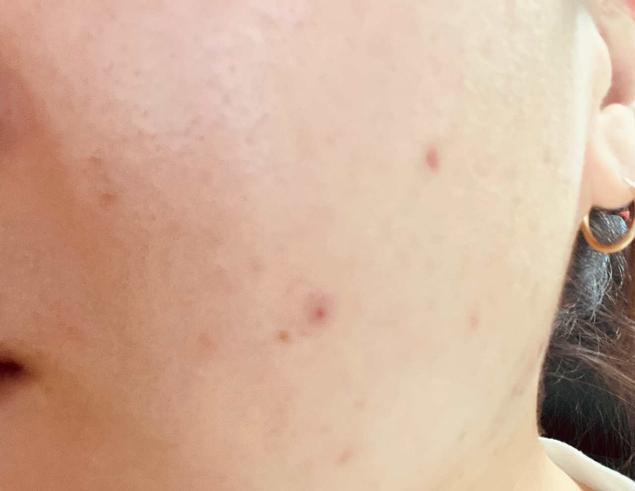 접촉성 피부염 연고 말고 얼굴 가려울때 관리법좀ㅠ