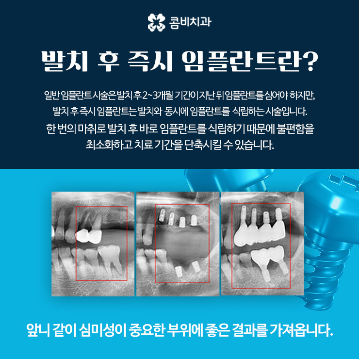 발치후 임플란트 시기 적기가 궁금해요 콤비 치과