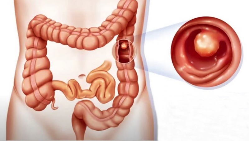 과형성 용종 원인 증상 치료 방법 및 예방법 대장 위 과형성 용종 포함