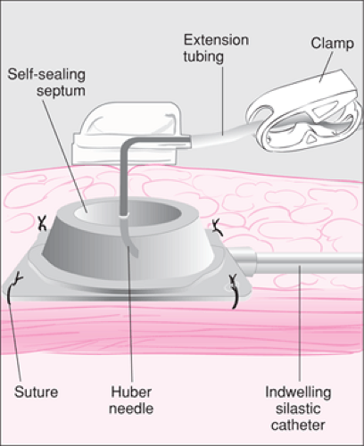 매립형 중심정맥관(Implanted Port): 케모포트(Chemoport)