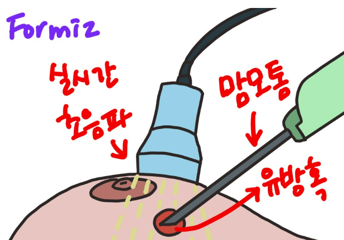 맘모톰 수술 비용 실비 맘모톰 후기유방 섬유선종 머니왕 코주부