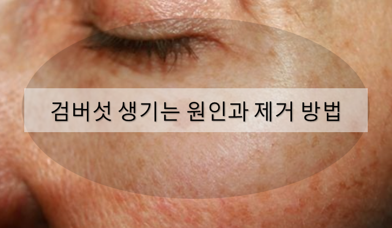 검버섯 생기는 원인과 제거 방법 호율안 소소한 이야기