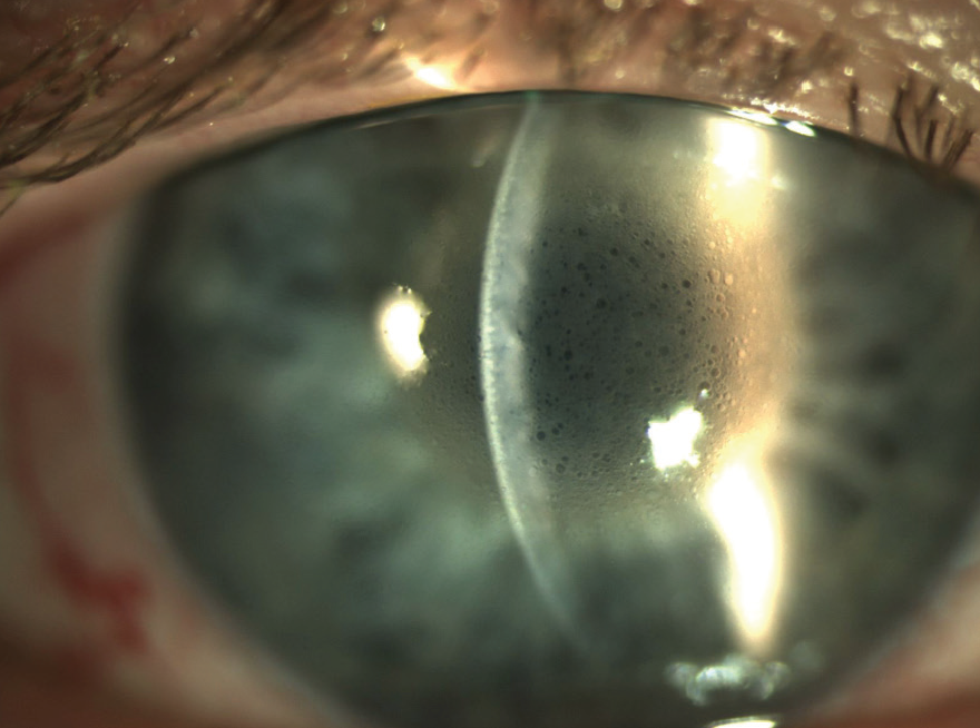Fuchs’ Endothelial Dystrophy, 푹스각막이상증, 푹스이영양증의 증상, 원인, 치료 녹내장, 각막이식