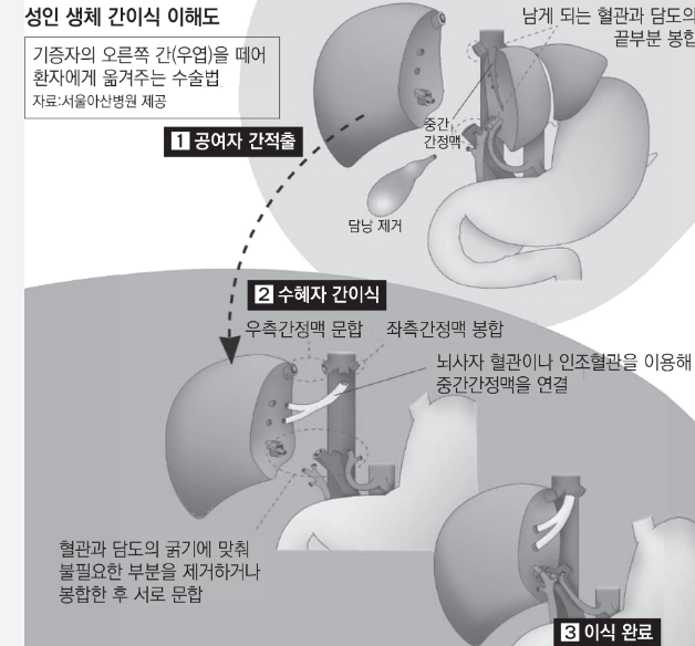 Ebs 간 이식 명의 주동진 교수 간경화 증상 간이식 방법 서울인포스트