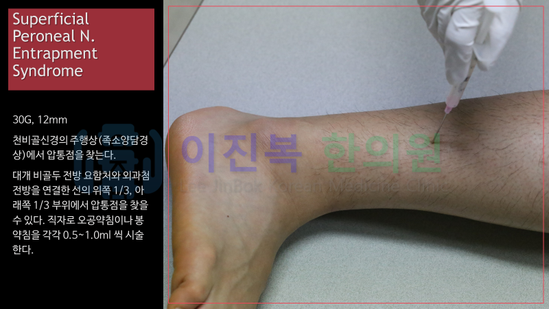 전주 이진복한의원 천비골신경포착증후군